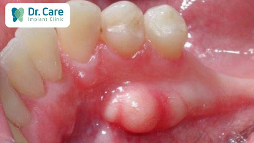 Nướu Răng Nổi Cục Thịt Không đau Có Nguy Hiểm Không Dr Care
